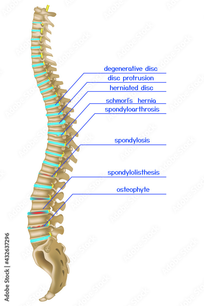 Damaged spine. Infographics of various back diseases. Vector ...