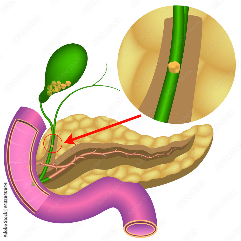 cholelithiasis. Formations in the gallbladder. Blockage of the bile ...