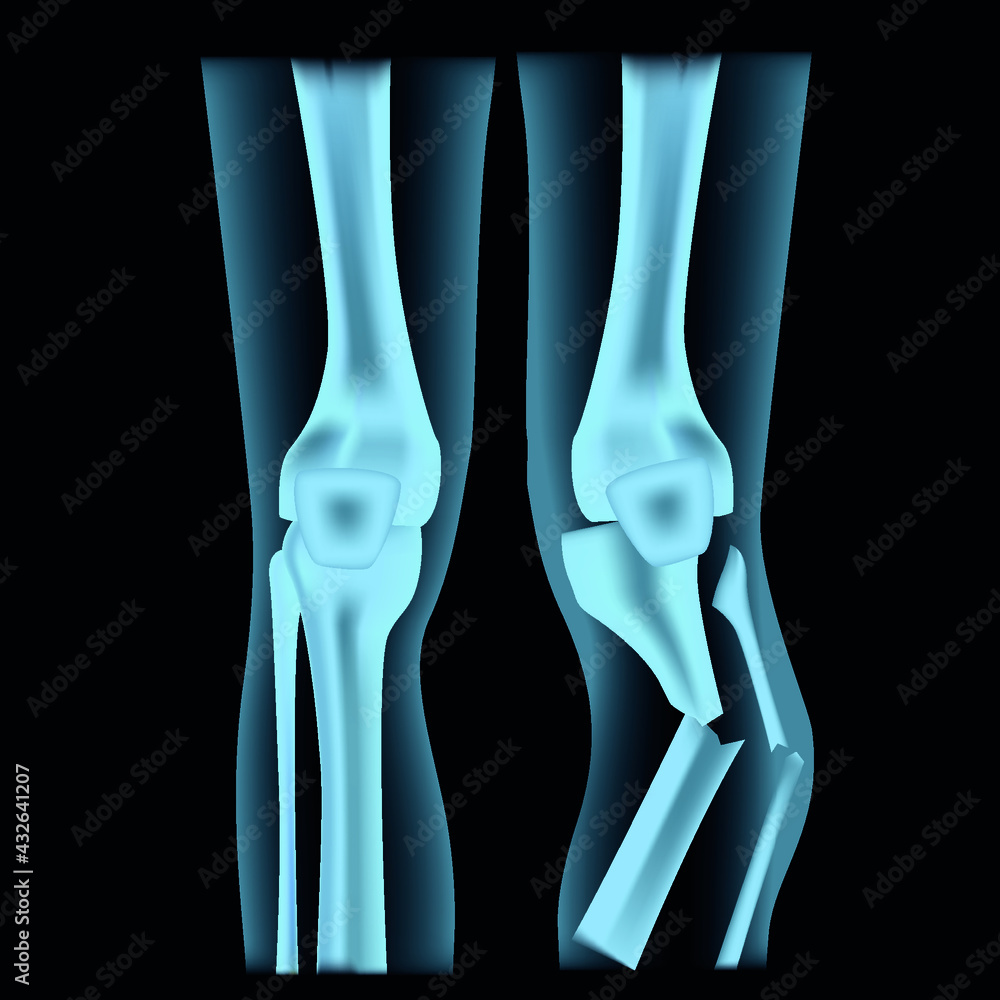 x-ray of human legs. Knee-joint. Open fracture with displacement ...