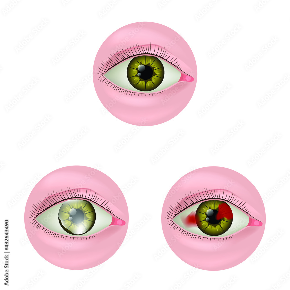 Corneal leukoma. Belmo. Eye damage. Eyeball bruising. Diseases of the ... Corneal leukoma. Belmo. Eye damage. Eyeball bruising. Diseases of the ...
