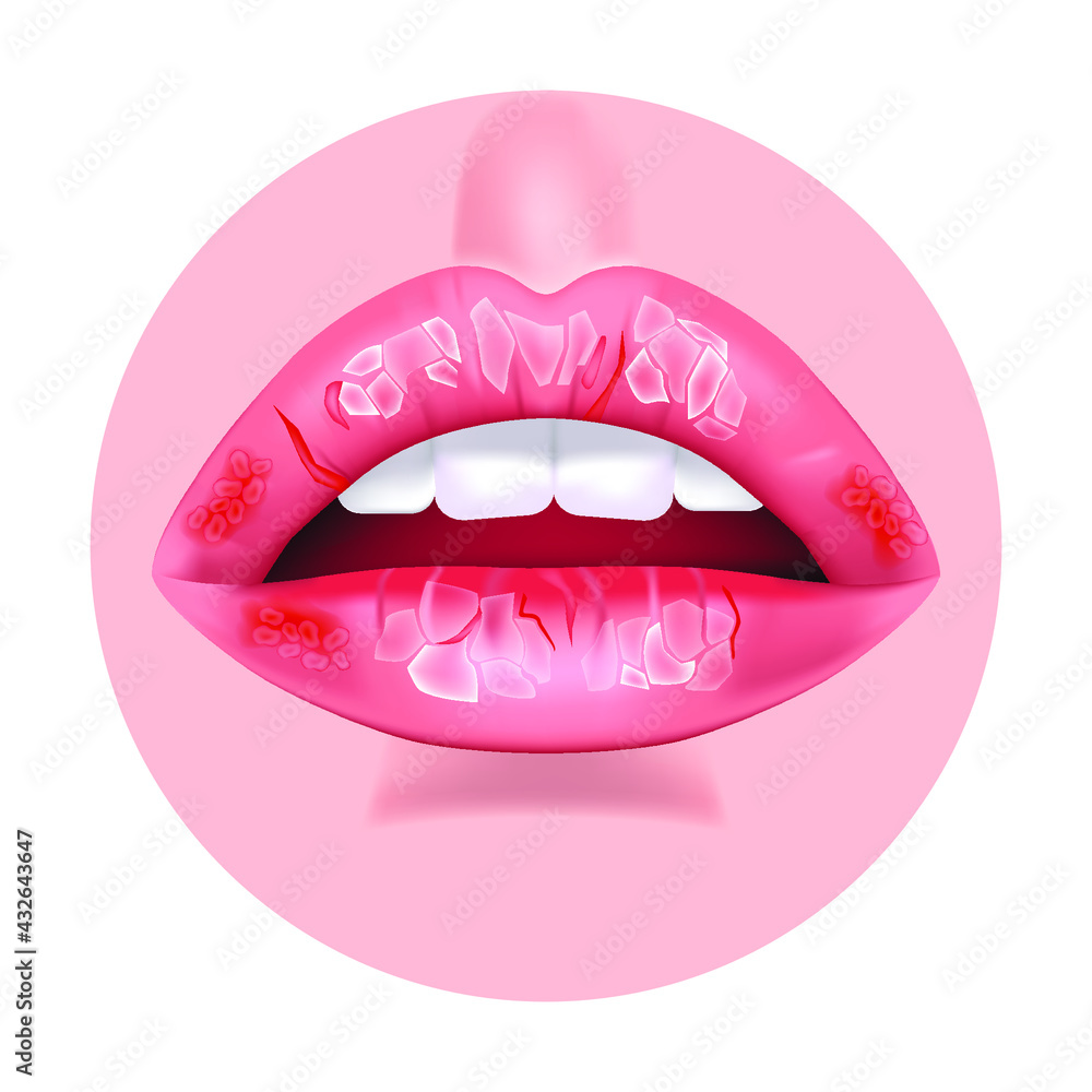 Chronic cheilitis. Dry chapped lips. Ripped skin. Disease of the mouth ...
