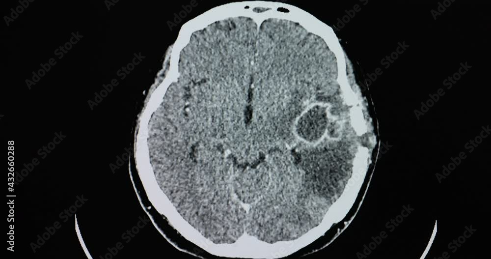 A CT brain scan of a patient with large abscess in the left temporal ...