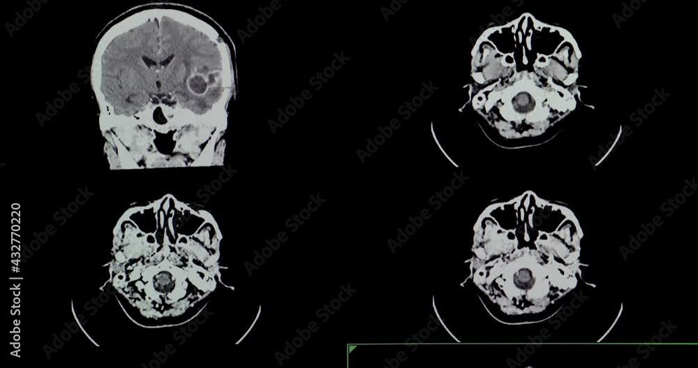 A CT brain scan of a patient with large brain abscesses in her left ...