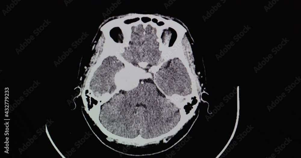 CT brain scan with contrast of a patient showing 3.8 cm rim enhancing ...