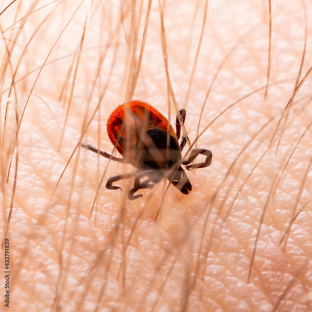 Infectious Encephalitis Ixodes Scapularis or Persulcatus Deer Tick ...