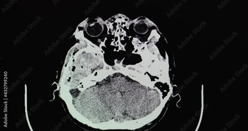 A CT brain scan of a patient with epidural hematoma at right temporal ...