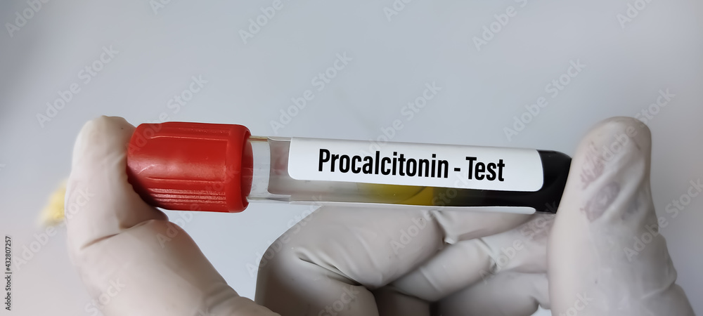 Blood sample tube and device or cassette for Procalcitonin test ...