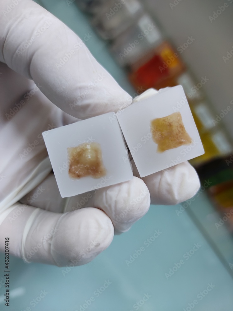 Paraffin blocks with cancer samples, samples for histological ...