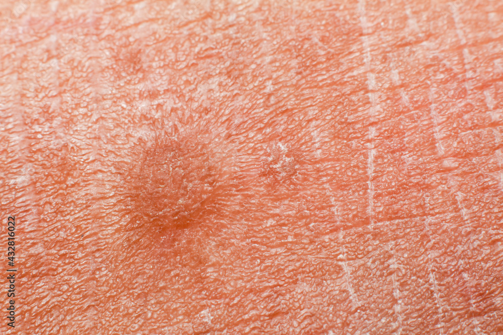 human skin texture. Flat wart on skin micro photo. close up photo ...