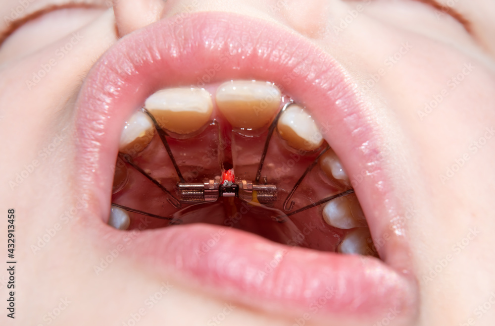 Teeth. Dental treatment. Open mouth with teeth alignment plate. A child ...