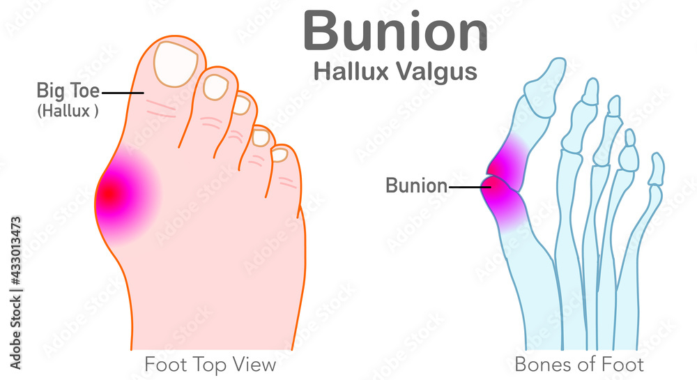 Bunion, Hallux valgus. Foot bones, joint deformed feet. Top view of the ...