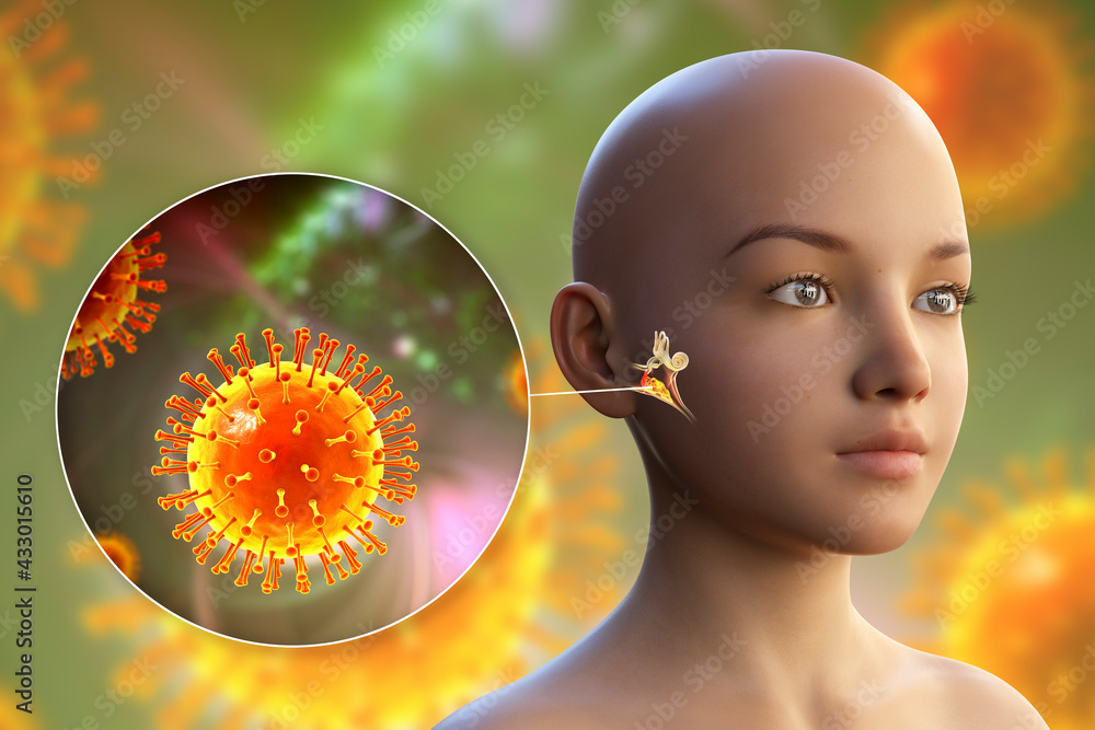 Viral otitis media, a group of inflammatory diseases of the middle ear ...