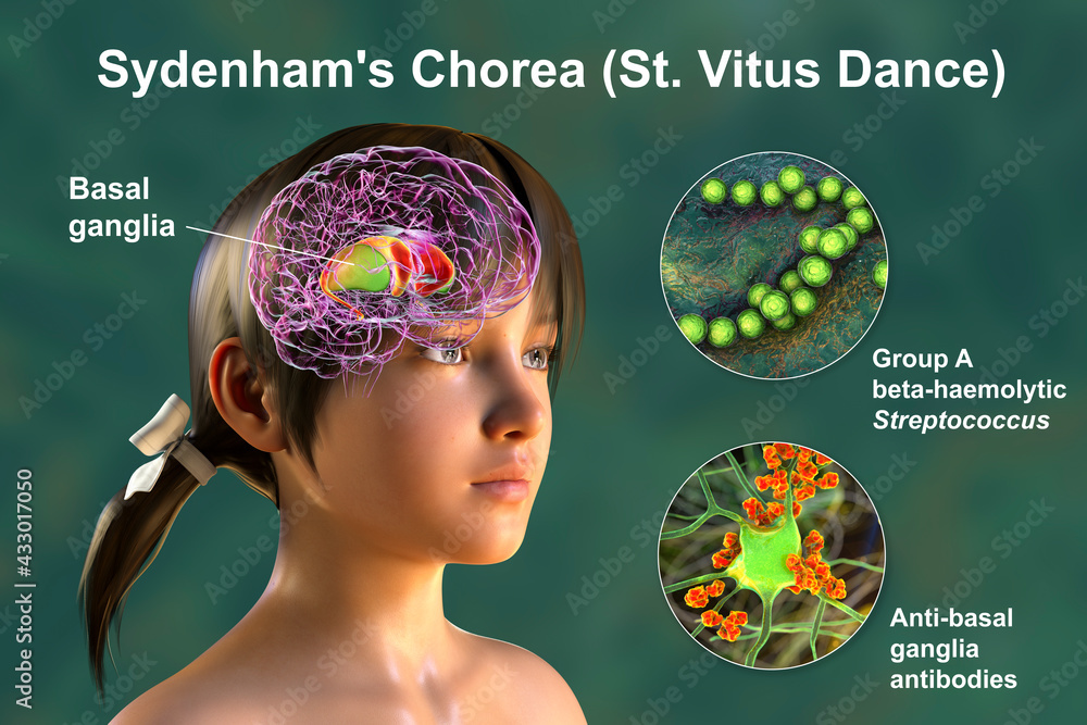 Sydenham's chorea, an autoimmune disease that results from ...