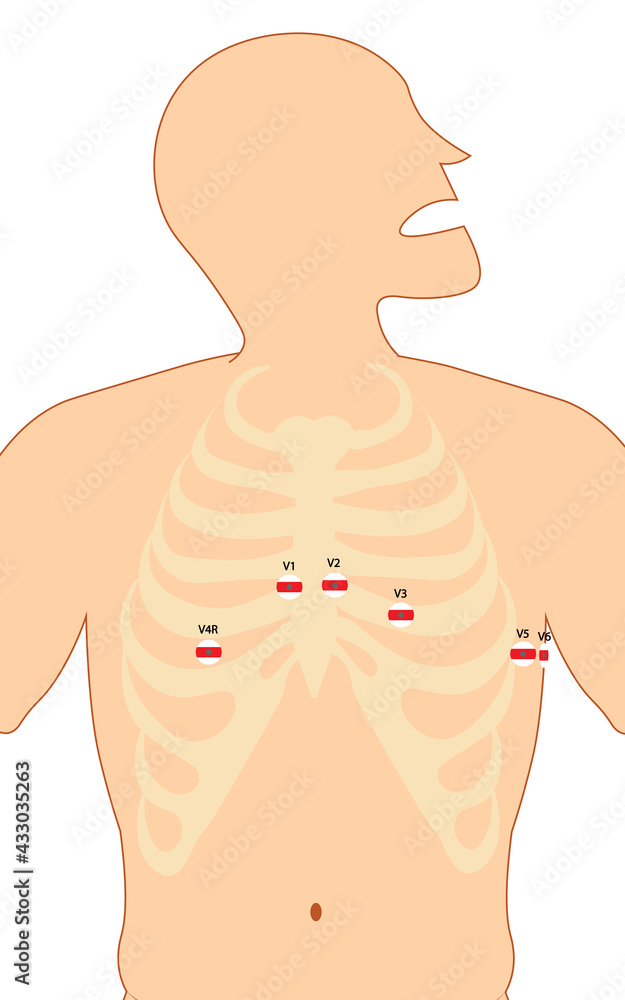 ECG (Electrocardiography) V4R ECG lead placement Stock-Illustration ...