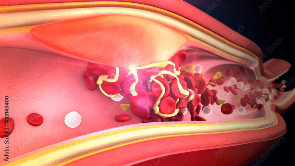 Blocked bloodstream, platelets and fibrin formating a blood clot inside ...