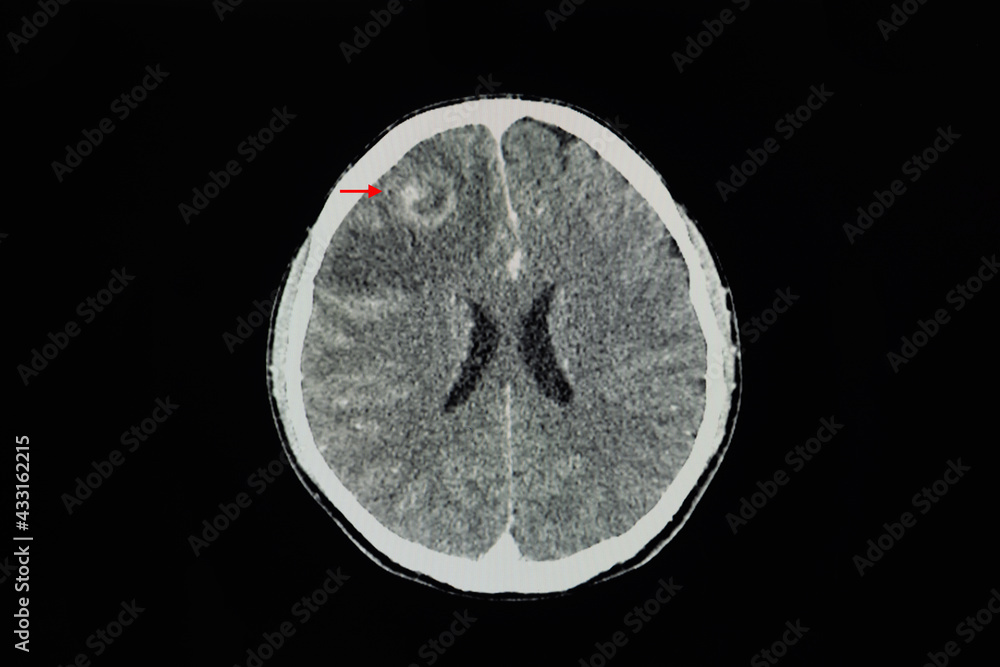 Brain Cat Scan Tumor