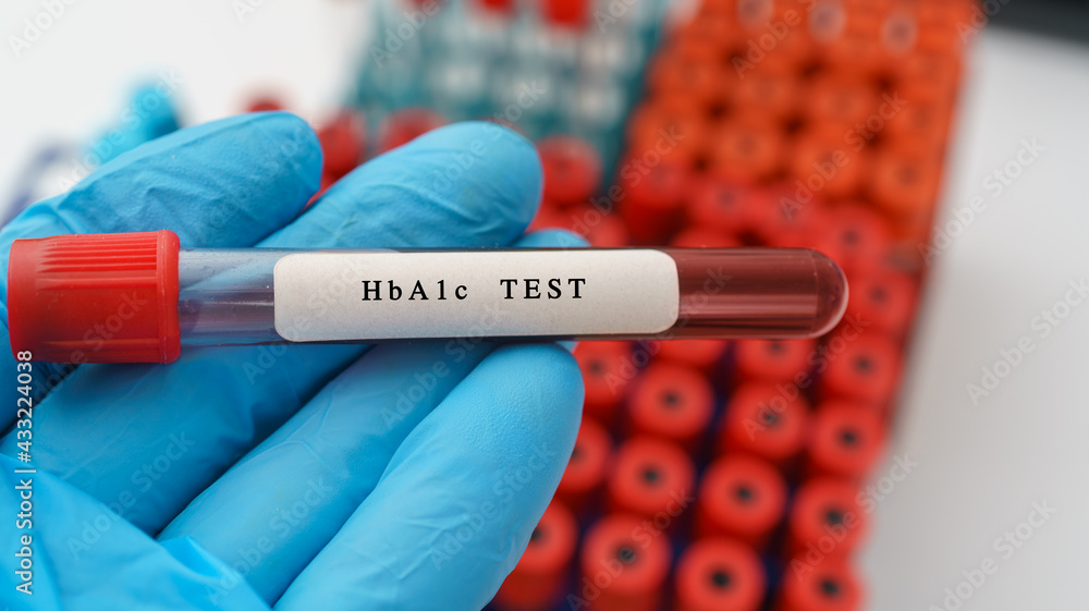 HbA1c diabetes diagnosis test result with blood sample in test tube on ...