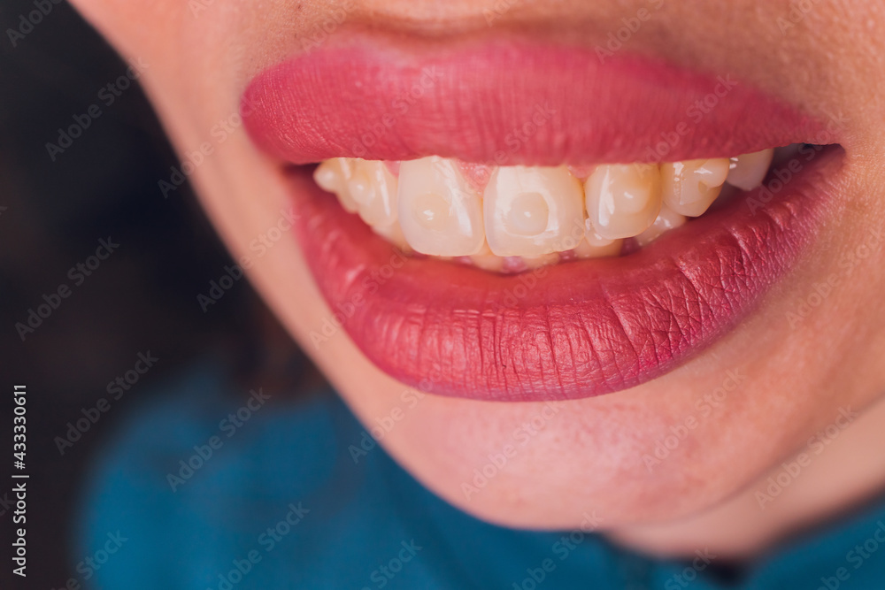 Brasket system in a girl's smiling mouth, macro photography of teeth ...