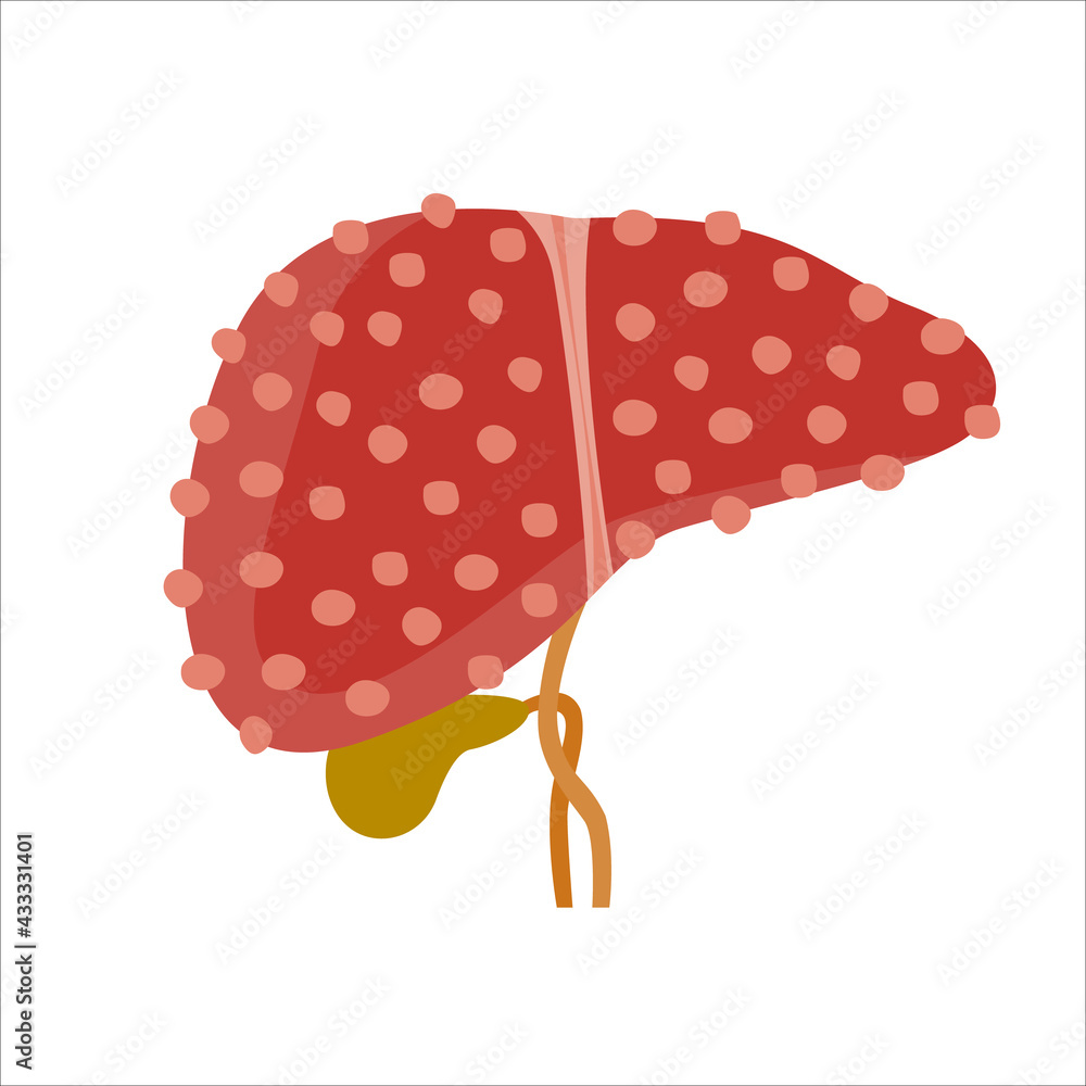 liver and liver disease. cirrhosis of the liver, hepatitis, fatty ...