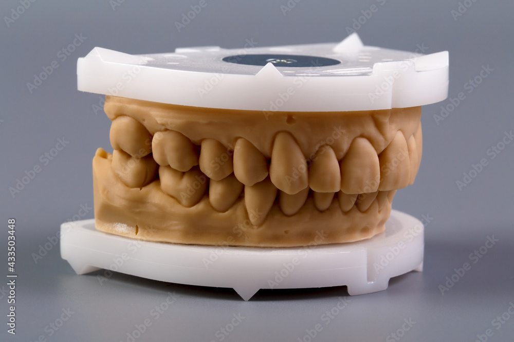 Mold of teeth. Gypsum model plaster of teeth. Plaster cast of teeth ...