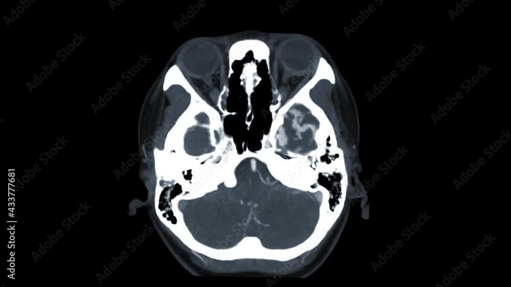 CTA Brain or computed tomography angiography of the brain Axial MIP ...