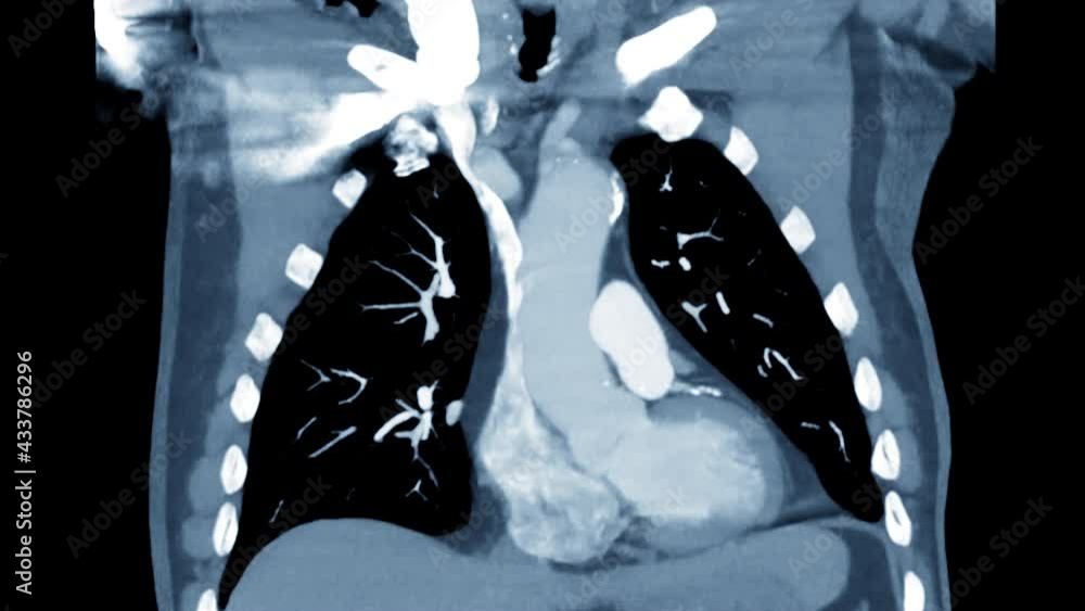 CTA Chest with contrast media Coronal MIP view for diagnostic Pulmonary ...