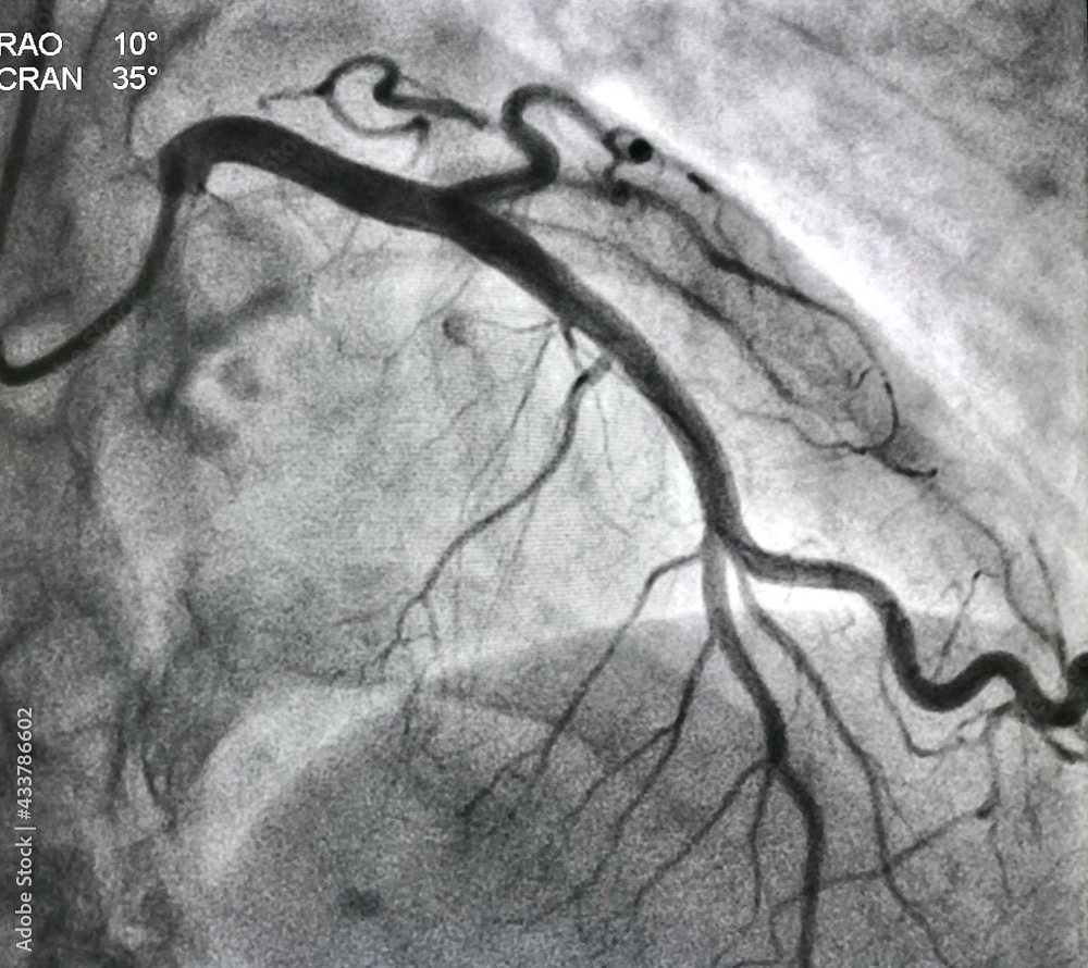 Normal coronary angiogram of left coronary artery during cardiac ...