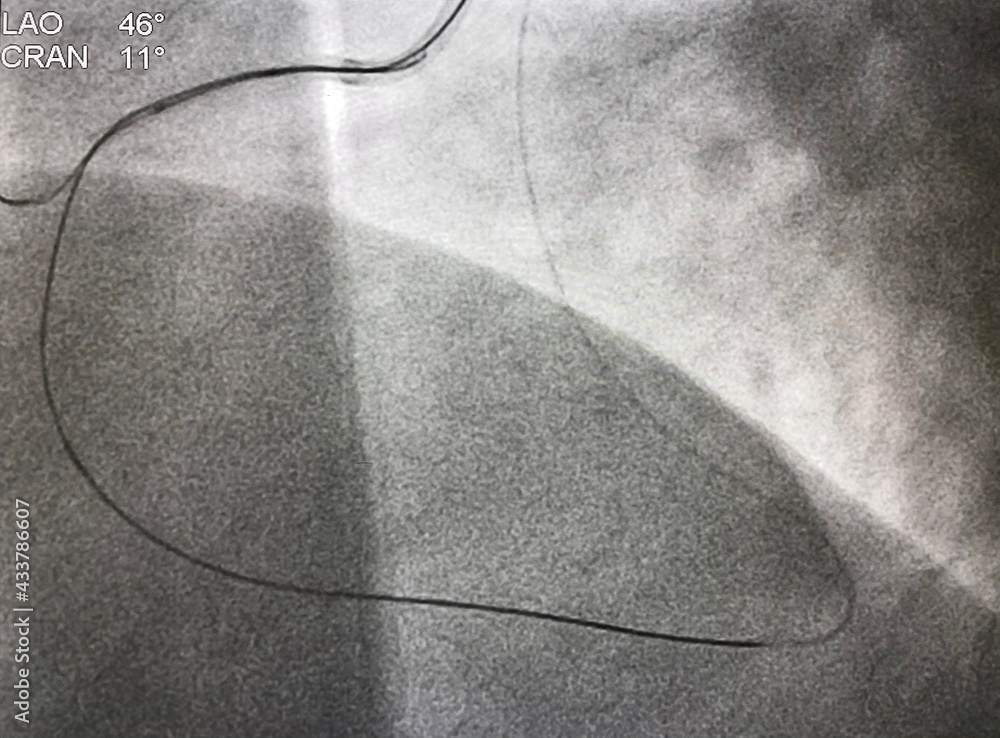 Retrograde guide wire to right coronary artery (RCA) in coronary ...