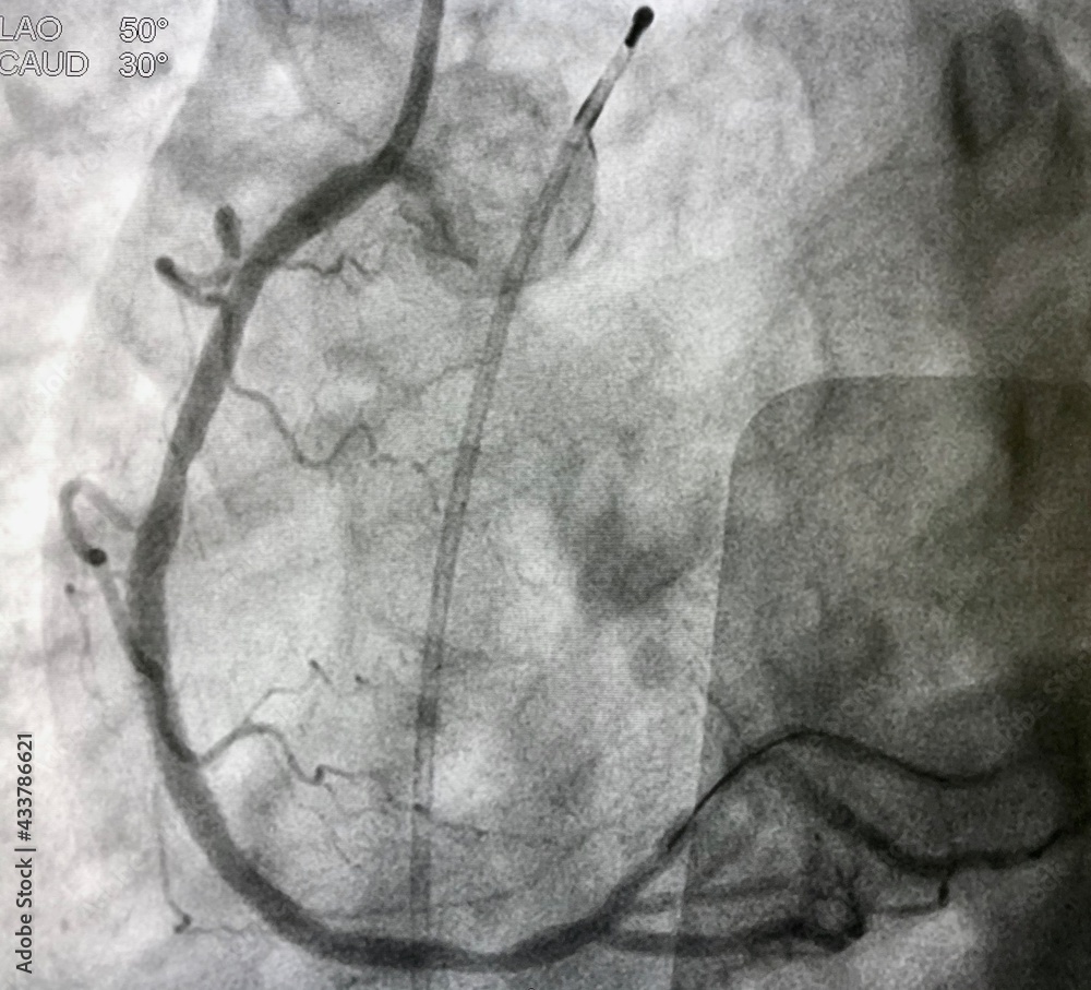 coronary angiography of ST elevation myocardial infarction (STEMI ...