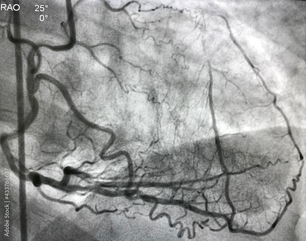 coronary angiogram showed right coronary artery (RCA) given collateral ...