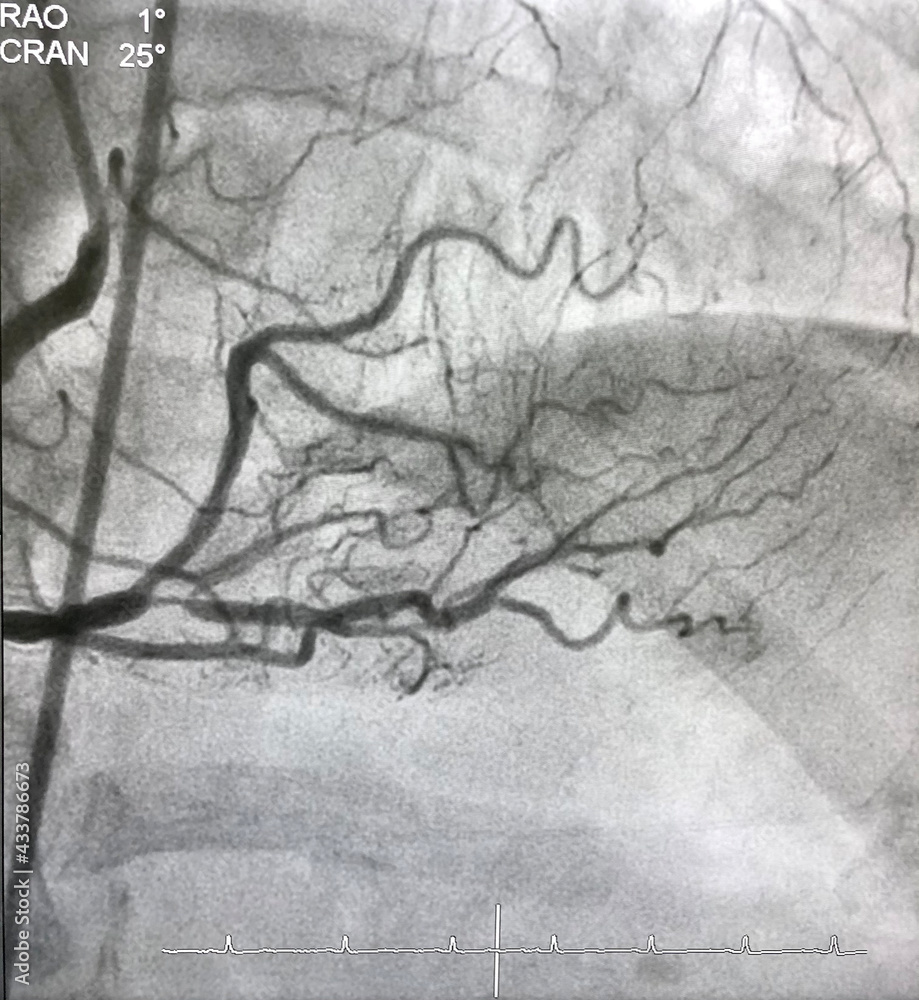 coronary angiogram showed right coronary artery (RCA) given collateral ...