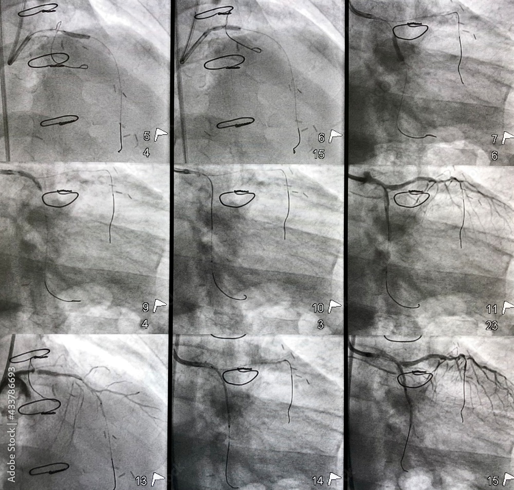 percutaneous coronary intervention at left coronary artery in patient ...