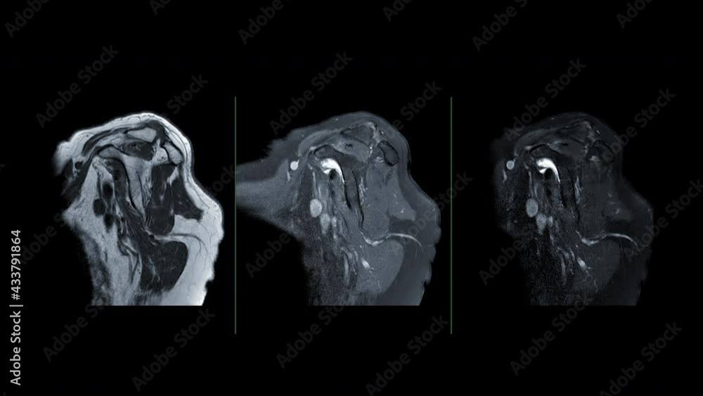 MRI shoulder or Magnetic resonance imaging (MRI) of Shoulder Joint ...