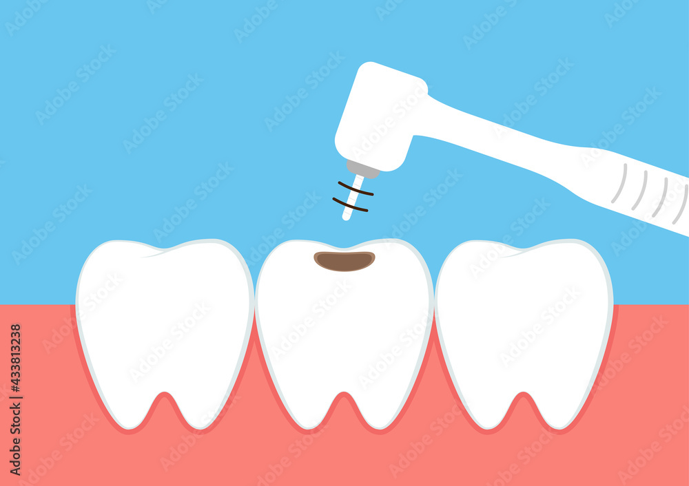Teeth cartoon vector. dental equipment vector. Tooth cavity. Stock ...