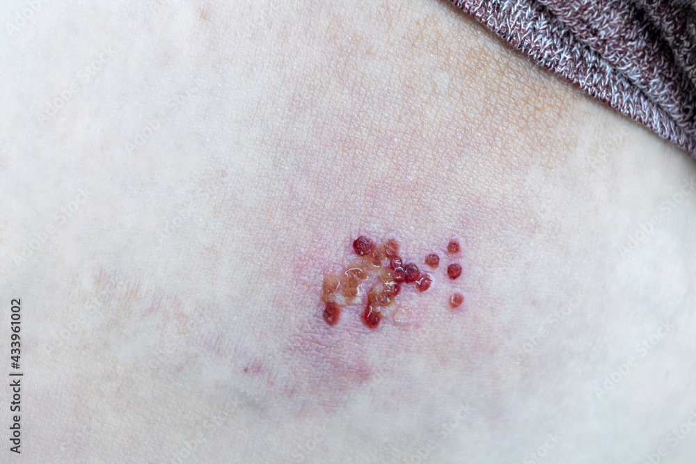 Woman with Shingles or Herpes Zoster on skin, it is raised red bumps ...