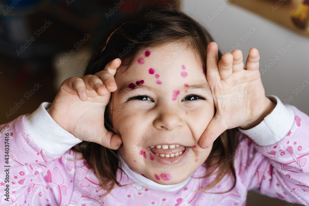 Toddler girl with chickenpox measles on the body. Varicella virus ...