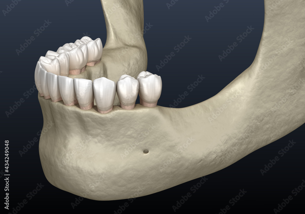 Mandibular Jaw, bone recession after losing molars teeth. Medically ...