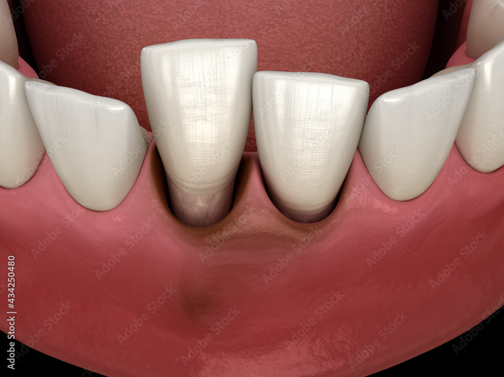 Tooth dislocation after trauma. Medically accurate 3D illustration ...