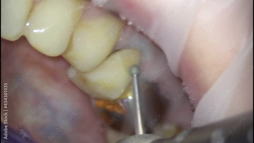 dentistry. shooting with a microscope. necrectomy. the dentist removes ...