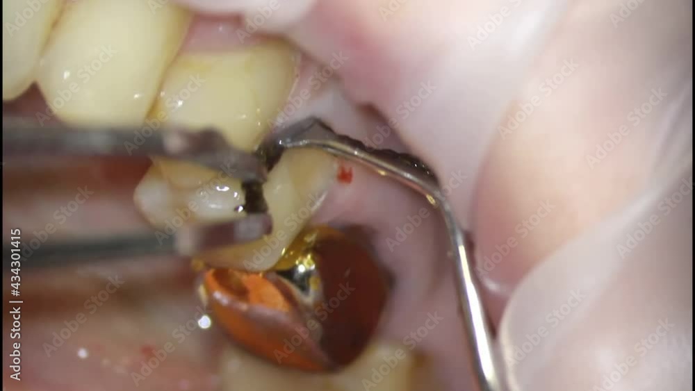 dentistry. shooting with a microscope. dental treatment. placement of a ...