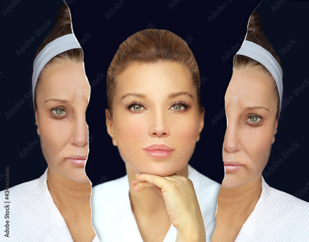 Plastic Surgery Results.Frown/scowl lines ,Nasolabial folds,Neck ,Under ...