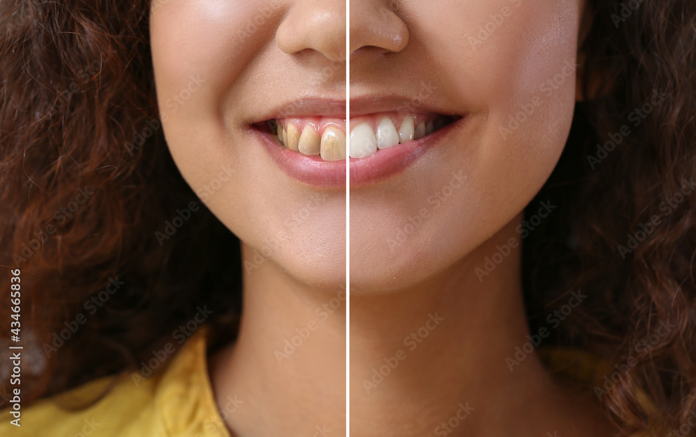 Beautiful young woman before and after smile makeover procedure ...