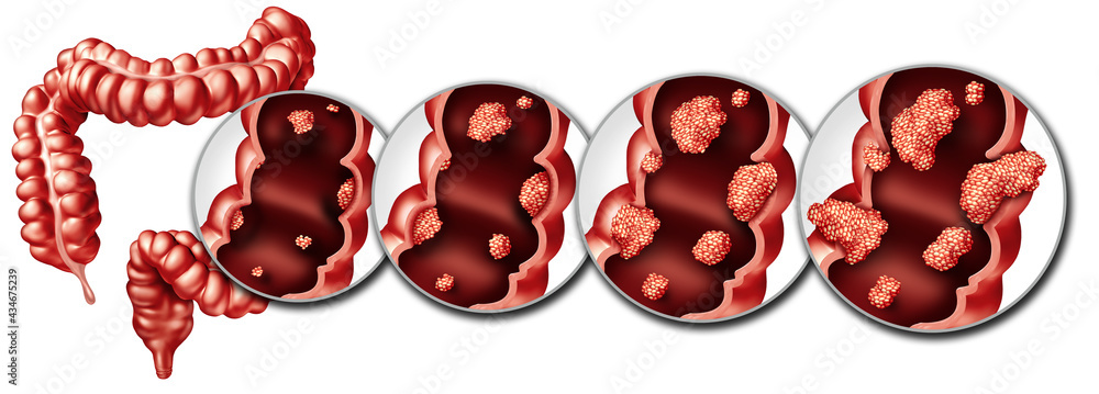 Colorectal Cancer Stock Illustration | Adobe Stock