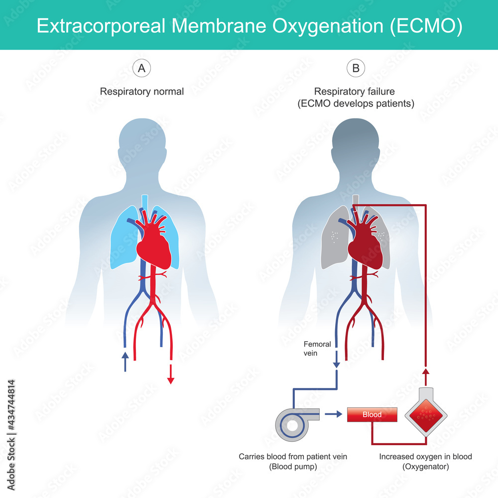 Extracorporeal membrane oxygenation. diagram for explain rescue ...