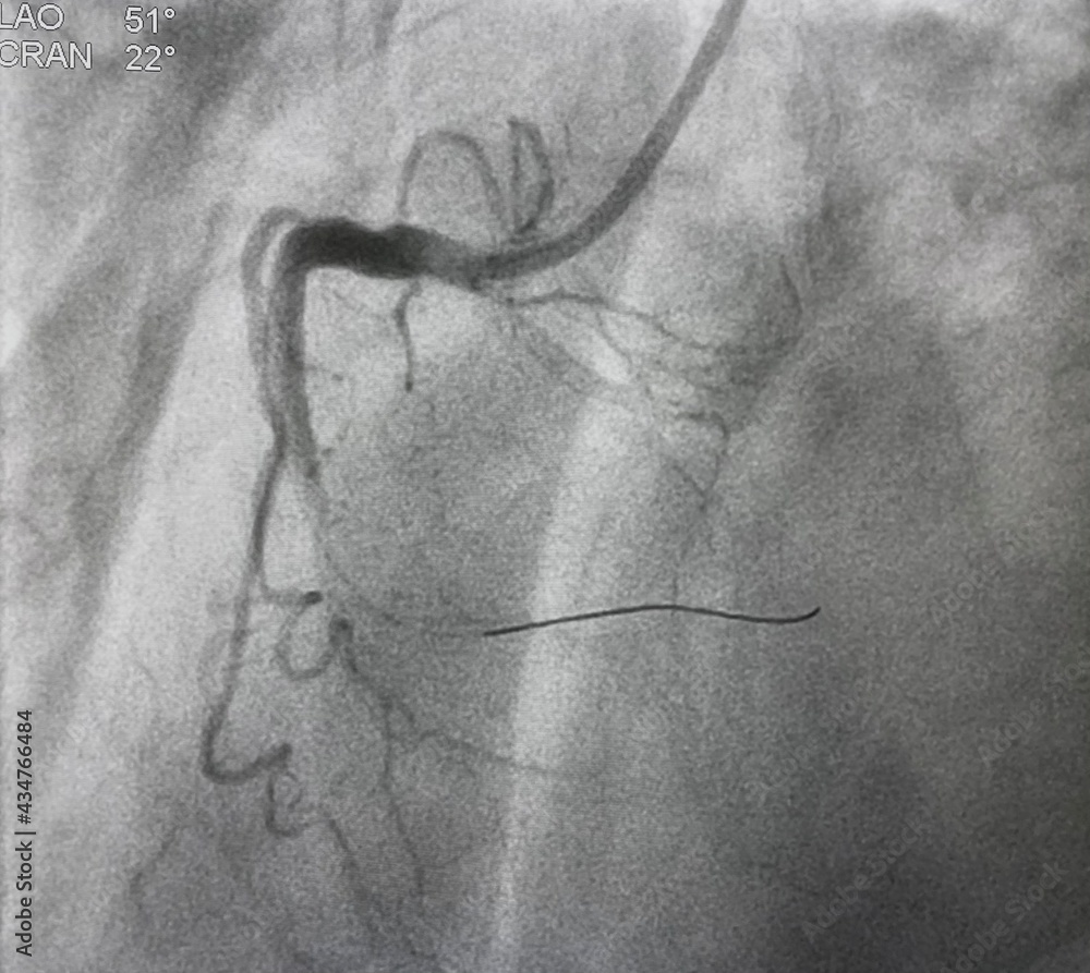 Foto de coronary angiogram shown massive thrombus that occluded right ...