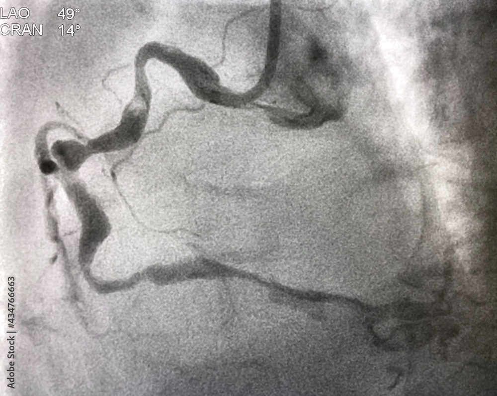 coronary angiogram shown massive thrombus that occluded right coronary ...