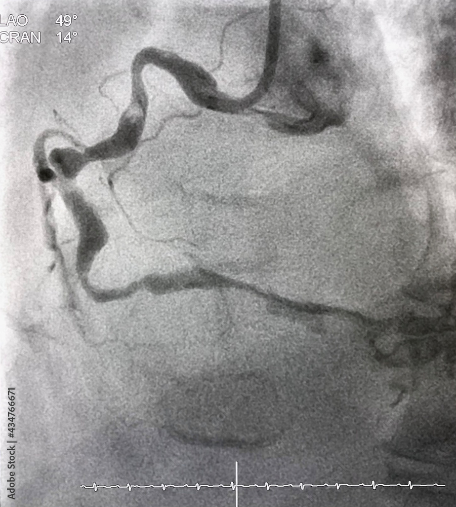 coronary angiogram shown massive thrombus that occluded right coronary ...