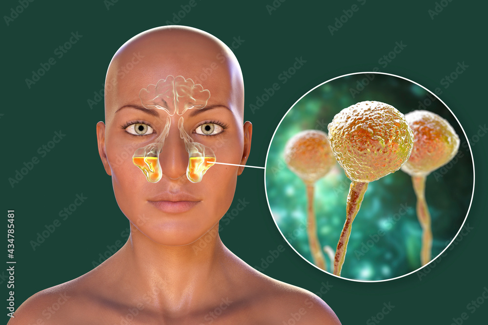 Mucor fungi as a cause of sinusitis, 3D illustration Stock Illustration ...