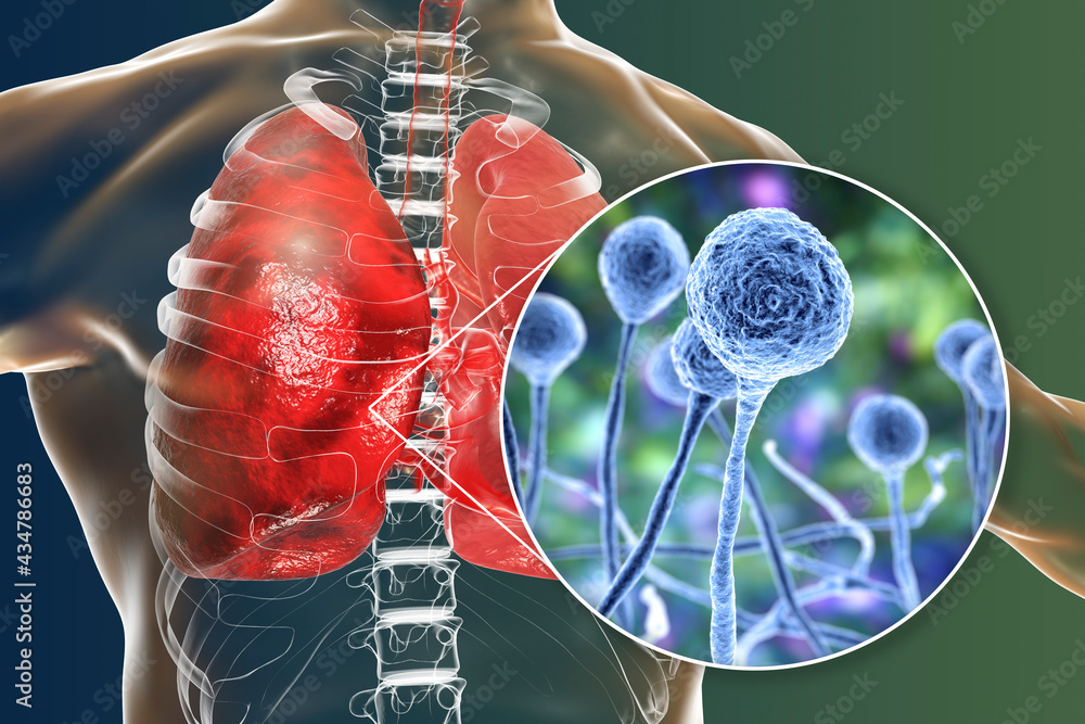 Lung mucormycosis, a lung disease caused by fungi Mucor, also known as black fungus Stock ...