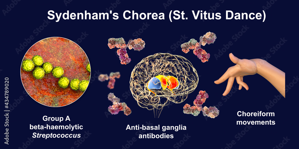 Sydenham's chorea, an autoimmune disease that results from childhood ...